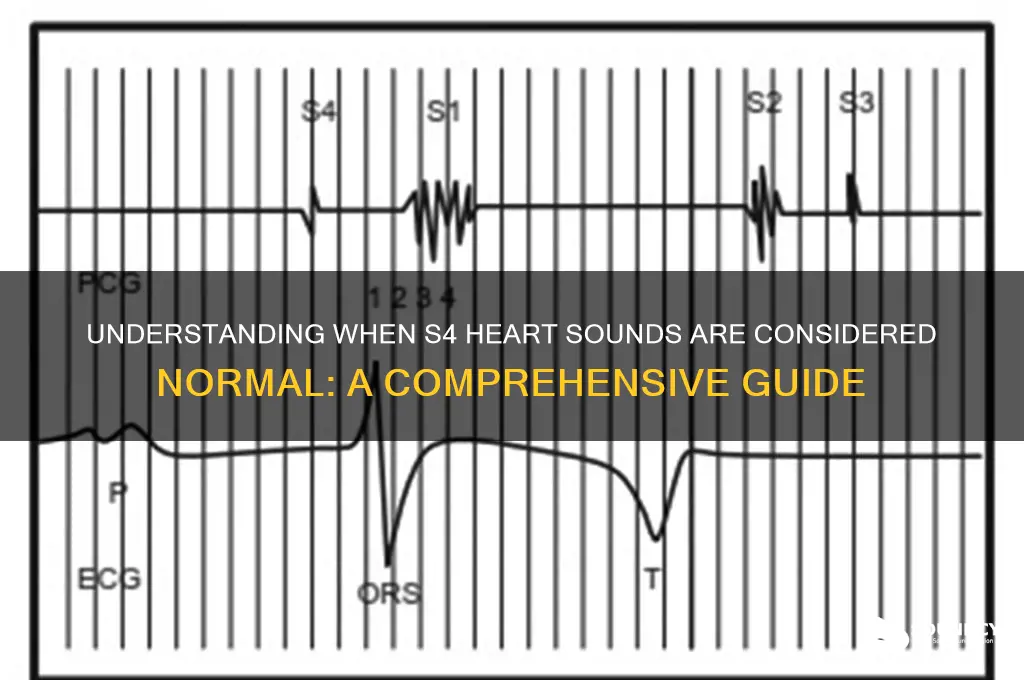 Understanding When S4 Heart Sounds Are Considered Normal: A ...
